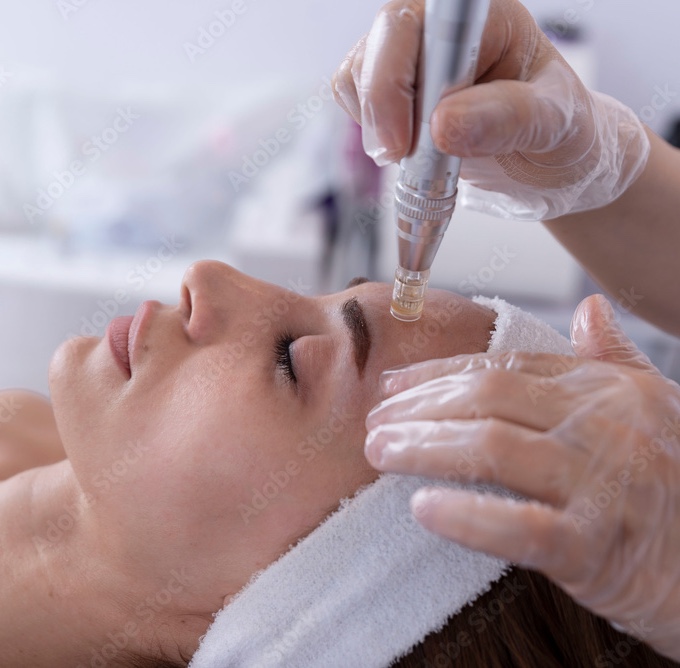 Best Microneedling | Kalon Skin Lab
